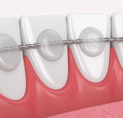 Dental Bonding in Millbrae CA | Broadway Dental of Millbrae